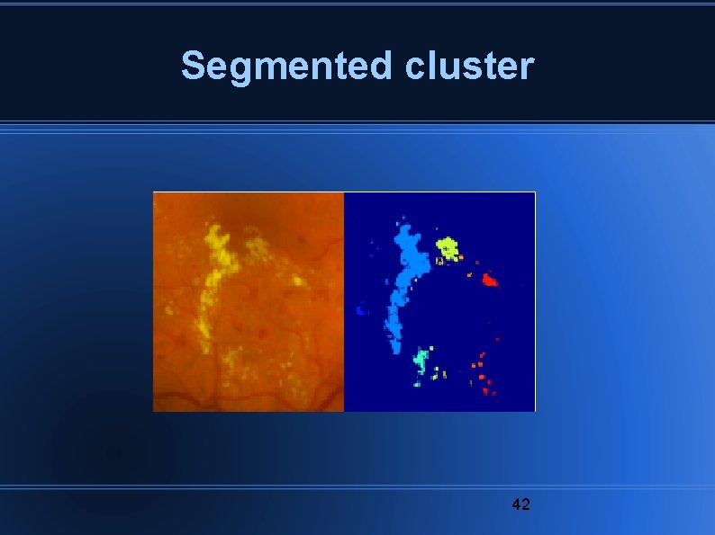 Detection of Diabetic retinopathy lesions in Color retinal