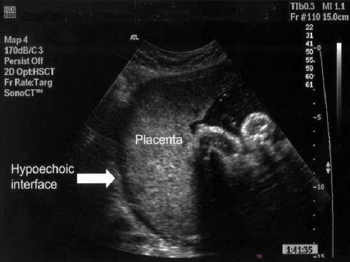 RETAINED PLACENTA Dr Mona Shroff www obgyntoday info