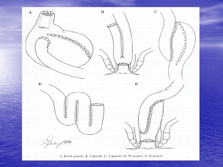 The Ilioanal Pouch Reservoir and Pouchitis What is