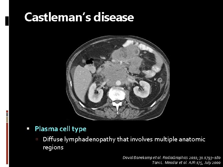 Castlemans disease hyaline vascular type Result of immunohistochemistry