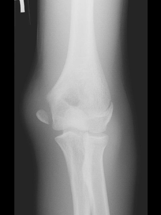 Athletic Injuries ATC 222 Elbow Forearm Wrist Hand