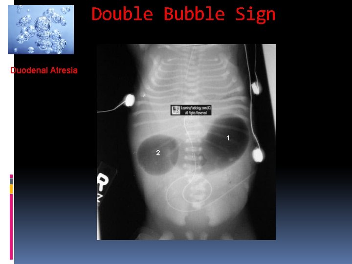 RADIOLOGY OF THE ABDOMEN Abdulaziz almanie MD Radiology