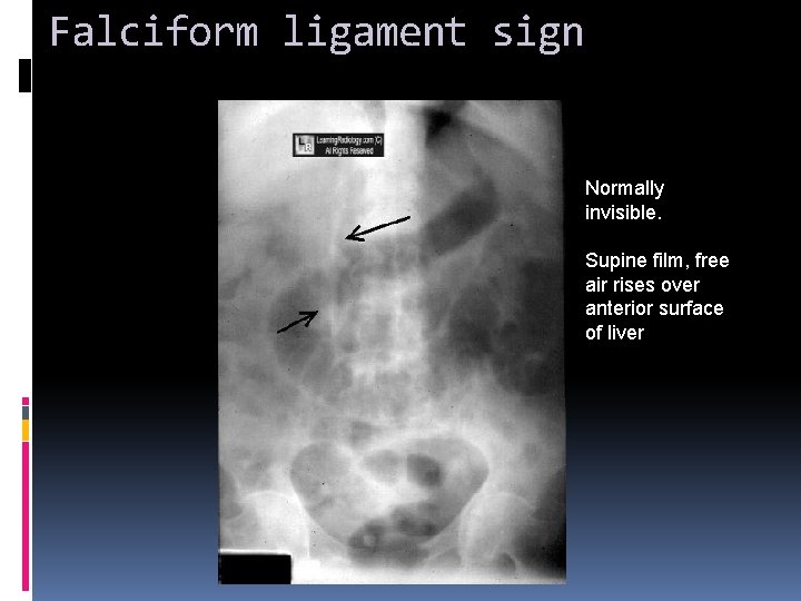 RADIOLOGY OF THE ABDOMEN Abdulaziz almanie MD Radiology