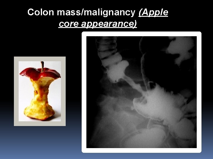 RADIOLOGY OF THE ABDOMEN Abdulaziz almanie MD Radiology