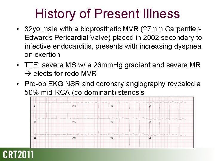 Acute Myocardial Infarction and Cardiac Arrest Due to