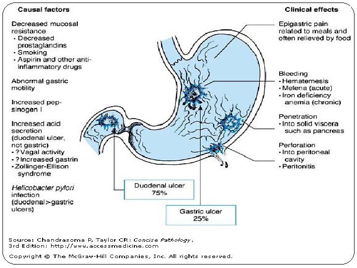 Benign Gastric and Duodenal diseases FAHAD BAMEHRIZ MD
