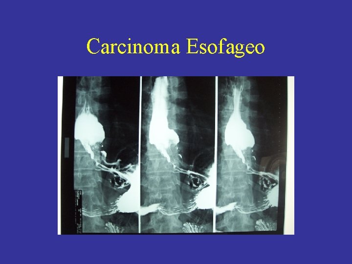 Presentazioni Cliniche Disfagia Ematemesi Vomito Dolore Tumefazione ...