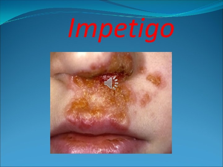 BACTERIAL SKIN DISEASES Prof Dr Eisha Abdel Moniem