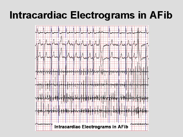 Physio Net Research Resource for Complex Physiologic Signals