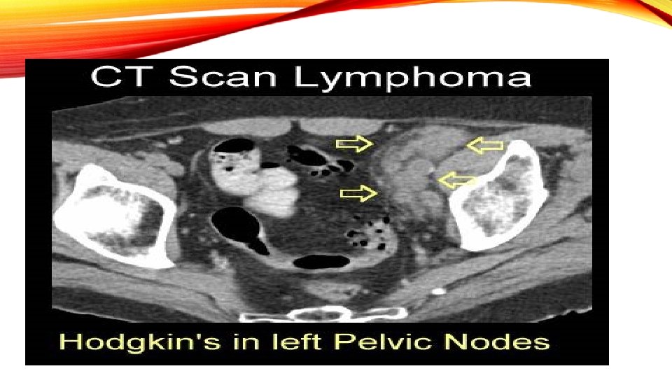 LYMPHOMA LEUKEMIA a closer look SEER HEMATOPOIETIC DATABASE