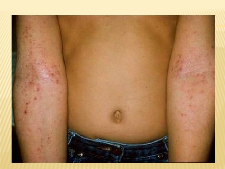 DERMATITIS ECZEMA By DR Eman ALMukhadeb OUTLINE Atopic