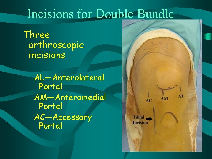 ACL Reconstruction Double Bundle VS Single Bundle Reconstruction