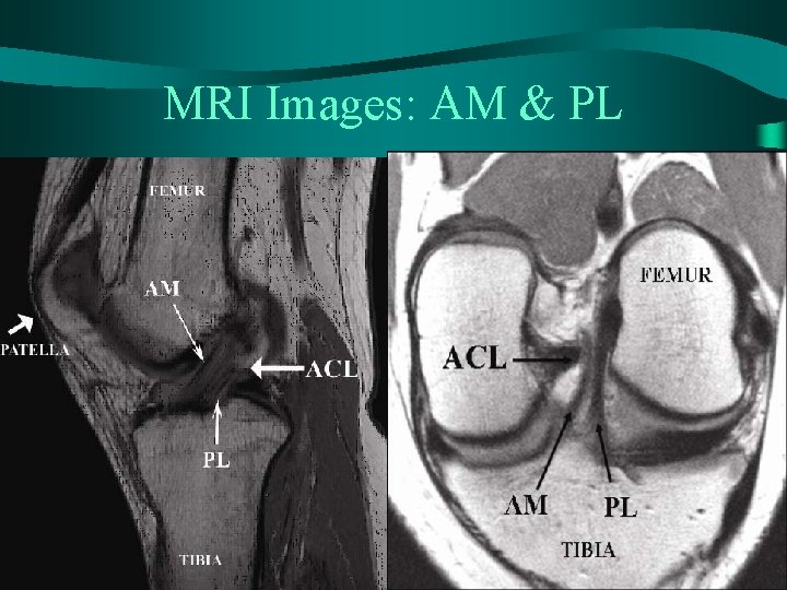 ACL Reconstruction Double Bundle VS Single Bundle Reconstruction