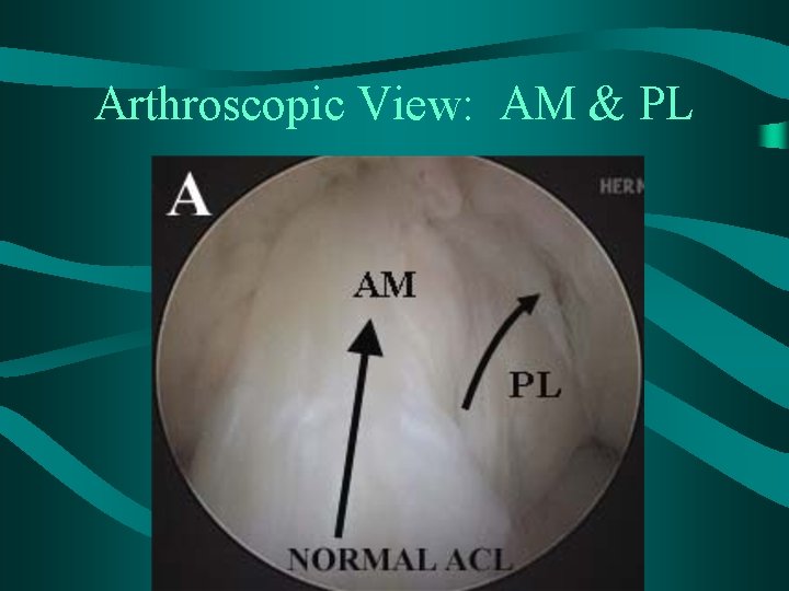 ACL Reconstruction Double Bundle VS Single Bundle Reconstruction