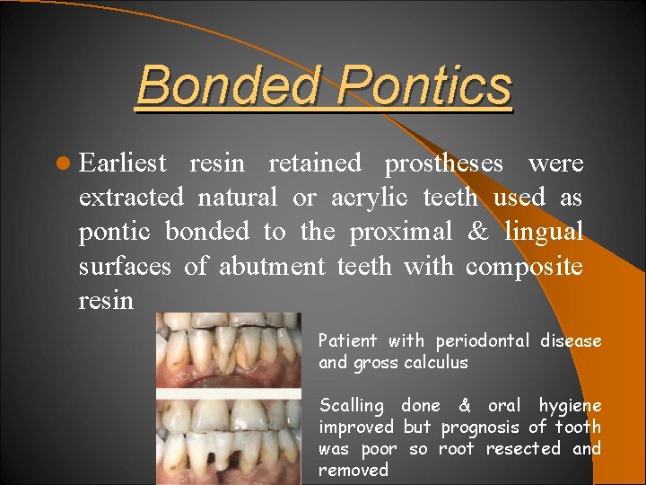RESIN BONDED FPDs DR MUHAMMAD RIZWAN MEMON F
