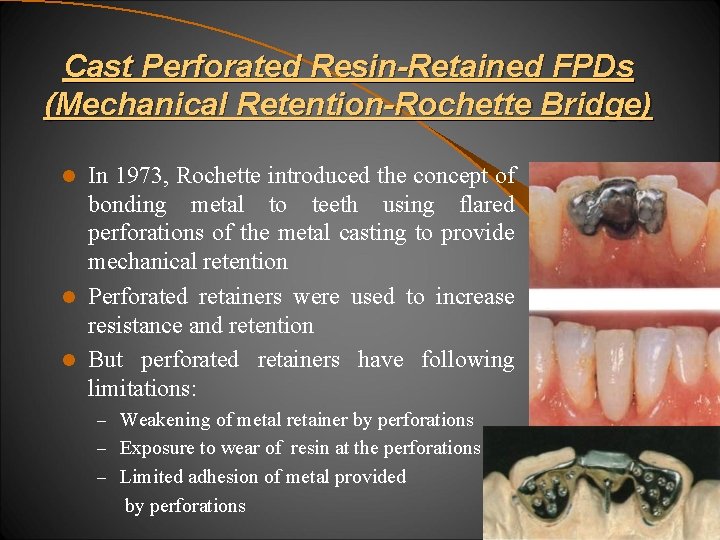 RESIN BONDED FPDs DR MUHAMMAD RIZWAN MEMON F