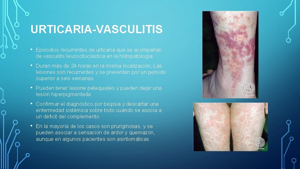 URTICARIA DIAGNOSTICO DIFERENCIAL DRA ADRIANA TQUEZ MUOZ DERMATOLOGA
