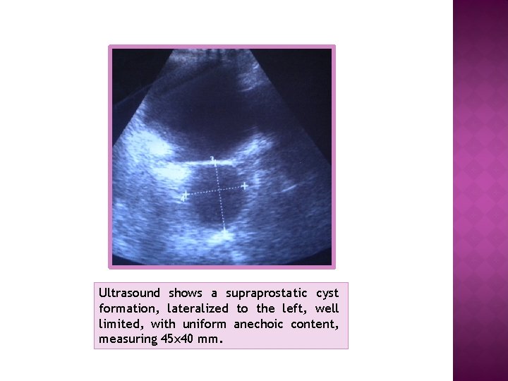URINARY UR 16 HEMORRHAGIC CYST OF VAS DEFERENS