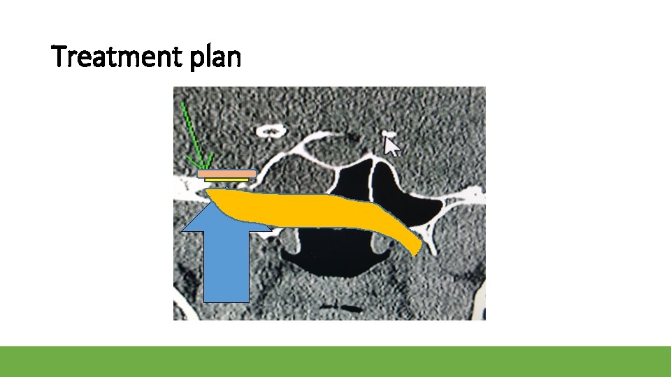Management of Cerebrospinal Fluid Leakage in Sphenoid Lateral