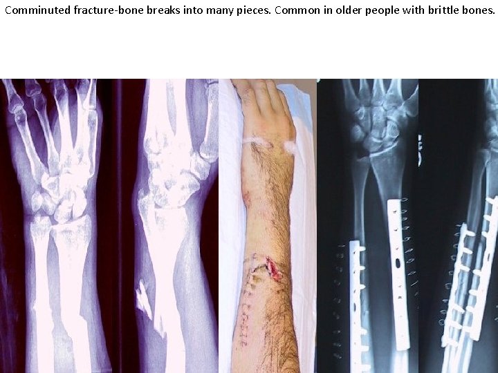 Bone Fractures Fracturebreak in a bone Types of