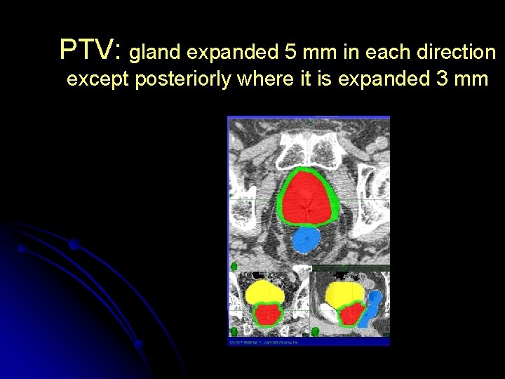 Stereotactic Body Radiation Therapy for Early Stage Prostate