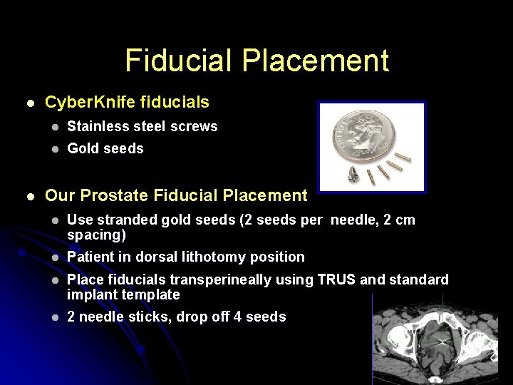 Stereotactic Body Radiation Therapy for Early Stage Prostate
