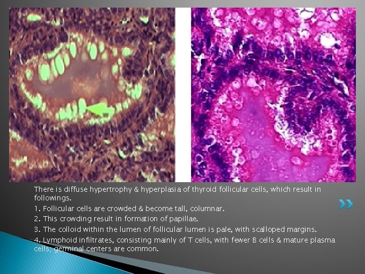 Thyroid gland pathology By Dr Mays Ibraheem Pathology
