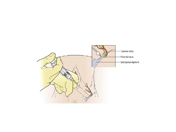 Analgesiaanesthesia Pudendal block local anesthetic is inltrated into