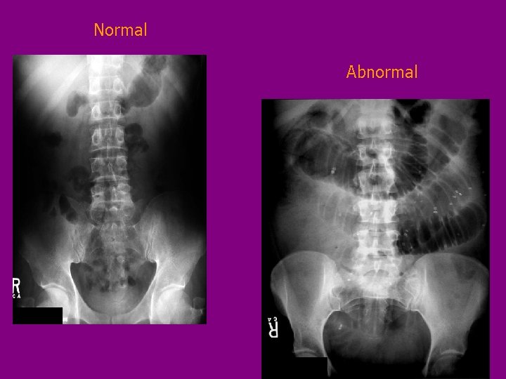 BASIC GI RADIOLOGY THE FLAT PLATE Michael Maristany