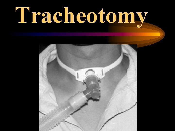 Tracheotomy What isTracheotomy The word tracheotomy is derived