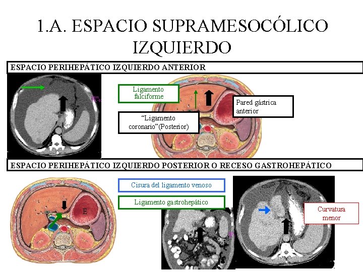 CAVIDAD PERITONEAL ESPACIO SUPRAMESOCLICO D I Ligamento falciforme