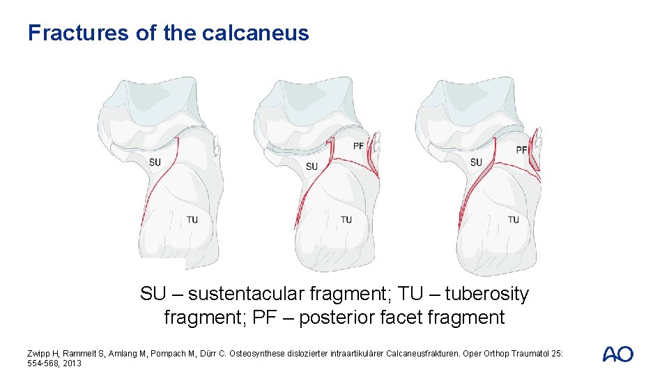 Calcaneal fracturespredicting and avoiding problems AO Trauma Advanced
