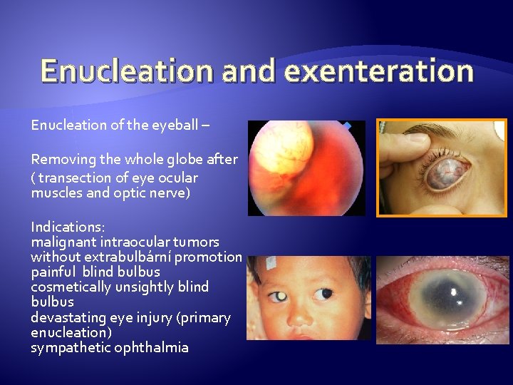 ORBIT MUDr Veronika Matukov Ph D FEBO Fractura