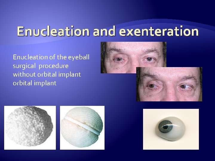 ORBIT MUDr Veronika Matukov Ph D FEBO Fractura