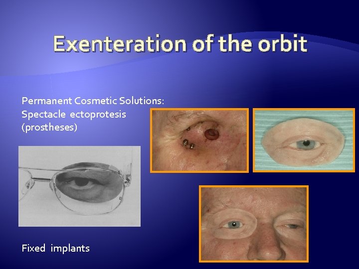 ORBIT MUDr Veronika Matukov Ph D FEBO Fractura