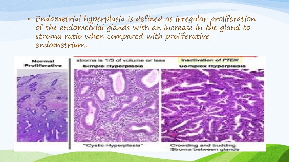 Management of Endometrial Hyperplasia D Hind Showman Endometrial