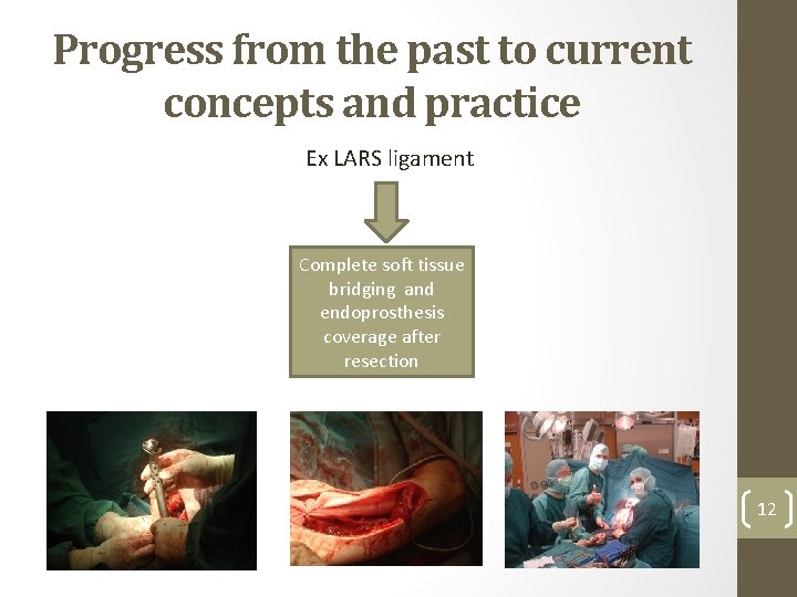 Limb Sparing surgery for bone tumors around the