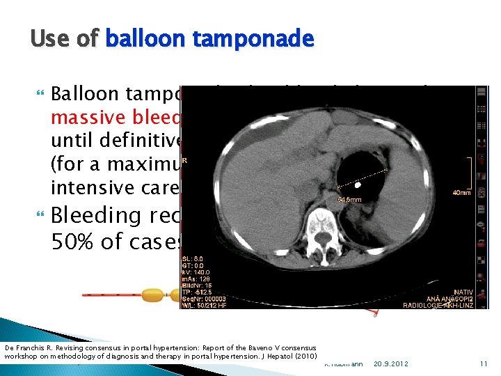 Stenting for acute variceal bleeding an update Rainer