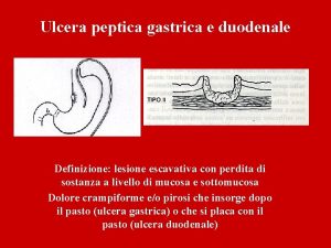 Ulcera peptica gastrica e duodenale Definizione lesione escavativa